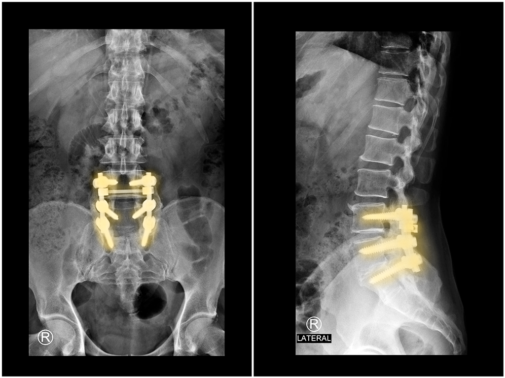 Instrumentaci n Lumbar Percut nea Dr Vidaurreta Instrumentaci n Lumbar Percut nea Dr Vidaurreta
